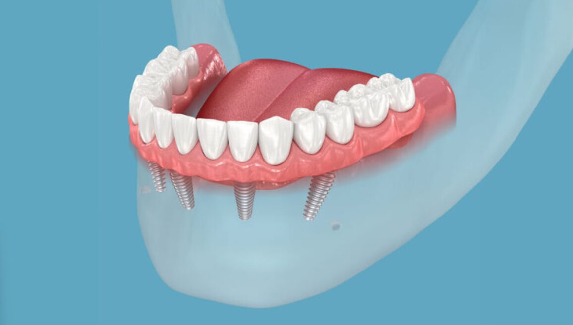 Full-arch implant rehabilitation: from the discovery of ...